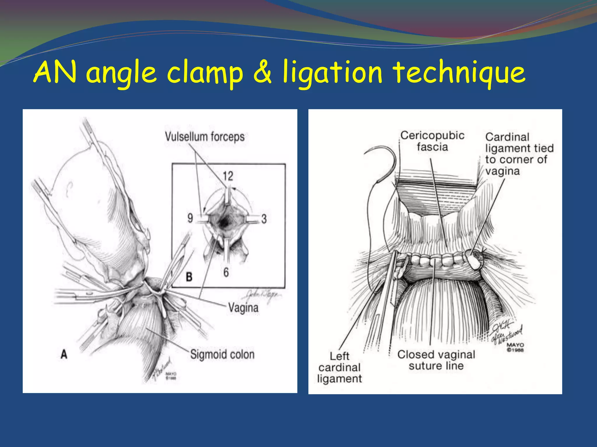 Preventing vault prolapse after hysterectomy | PDF