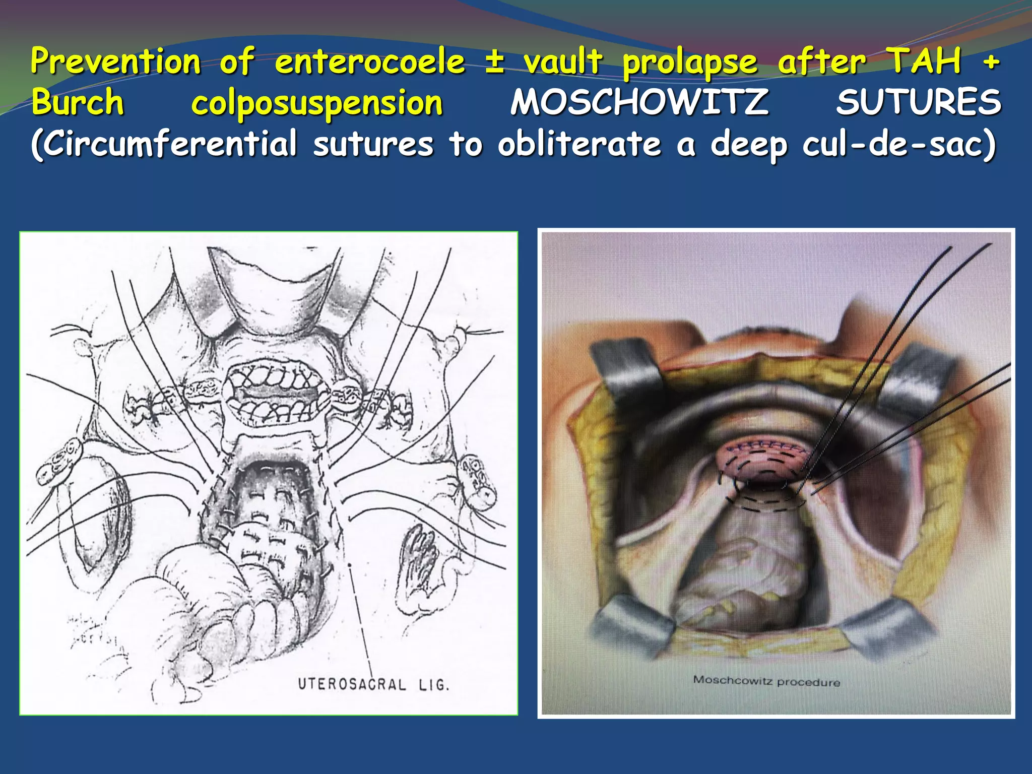 Preventing vault prolapse after hysterectomy | PDF