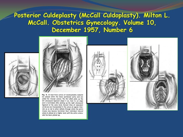 Preventing vault prolapse after hysterectomy | PDF | Reproductive ...