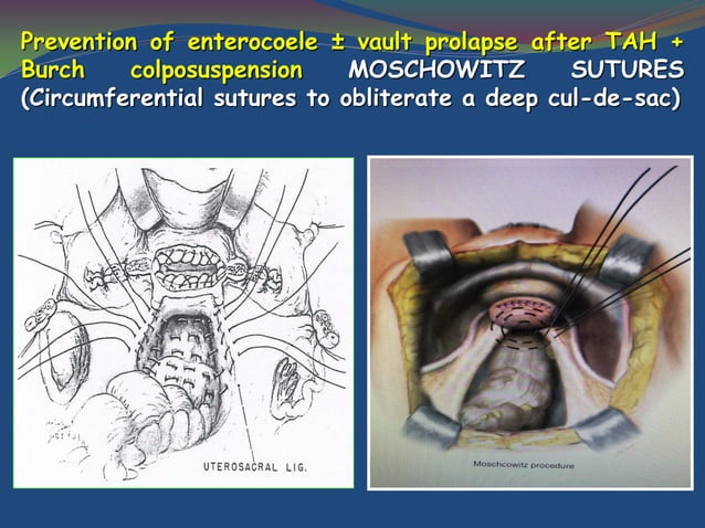 Preventing vault prolapse after hysterectomy | PDF | Reproductive ...