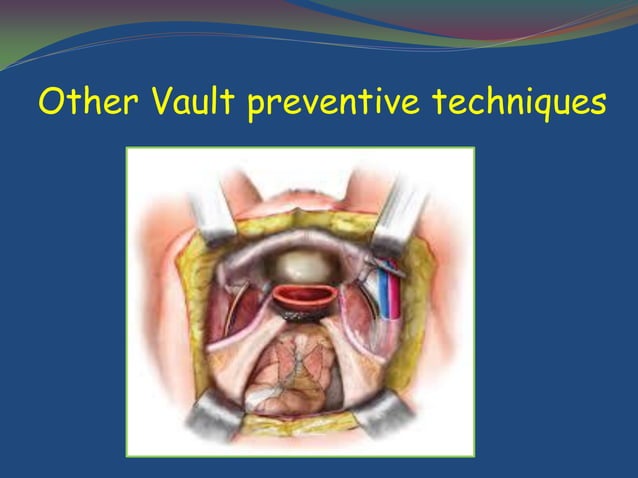 Preventing vault prolapse after hysterectomy