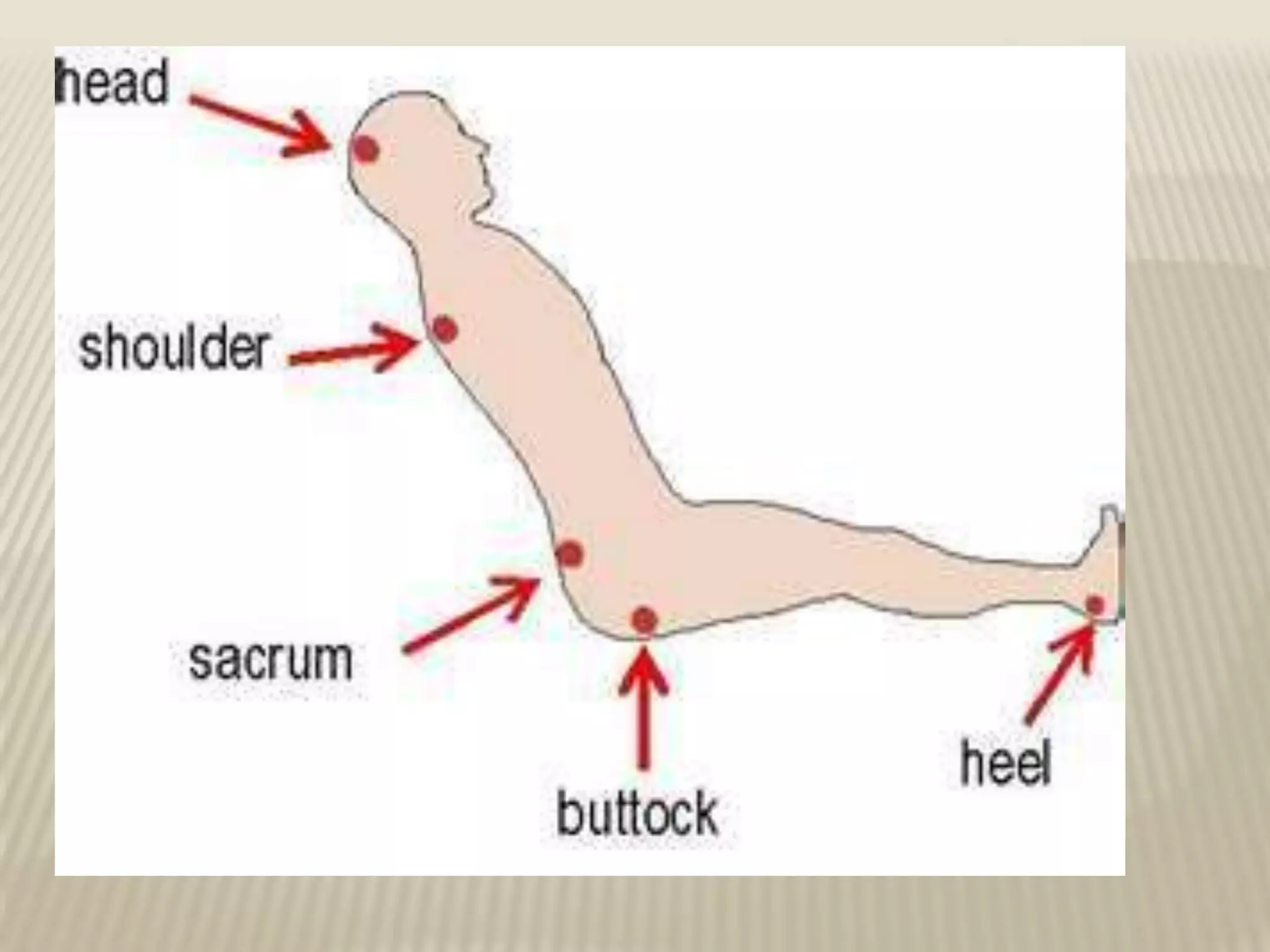 Prevention and care of pressure sore | PPTX