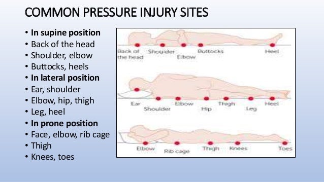Prevention and management of pressure injury