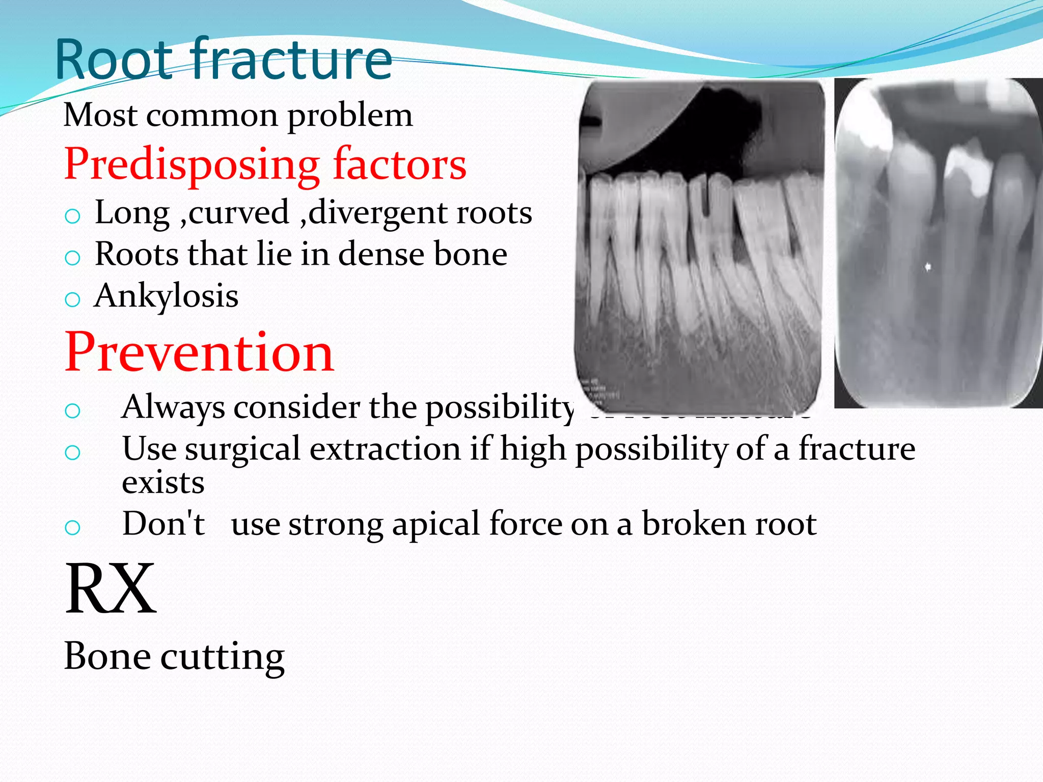 Prevention and managment of extraction complication | PPTX