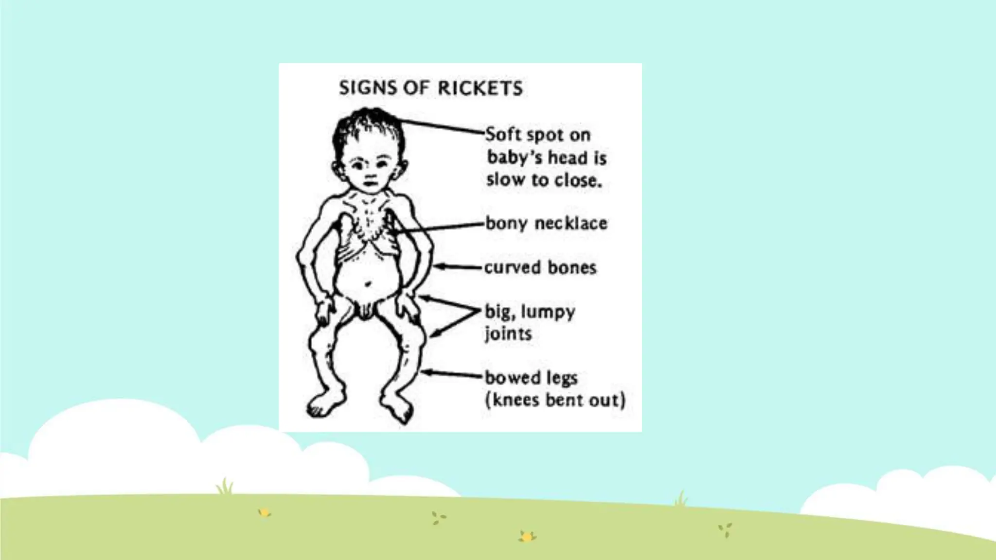 Prevention and Treatment of Rickets in children.pptx