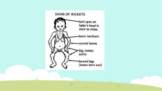 Prevention and Treatment of Rickets in children.pptx