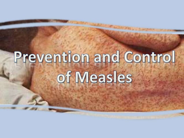 Prevention & control of exanthematous fever | PPT