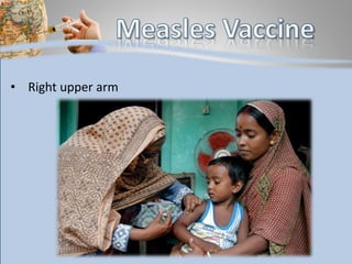 Prevention & control of exanthematous fever | PPTX