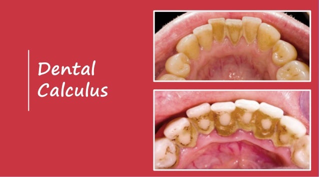 Dental Calculus Animals