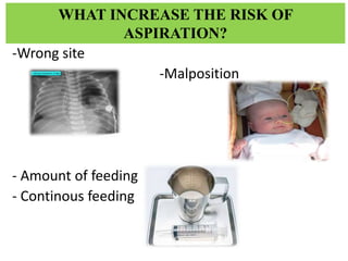 Prevention of aspiration 2 | PPTX