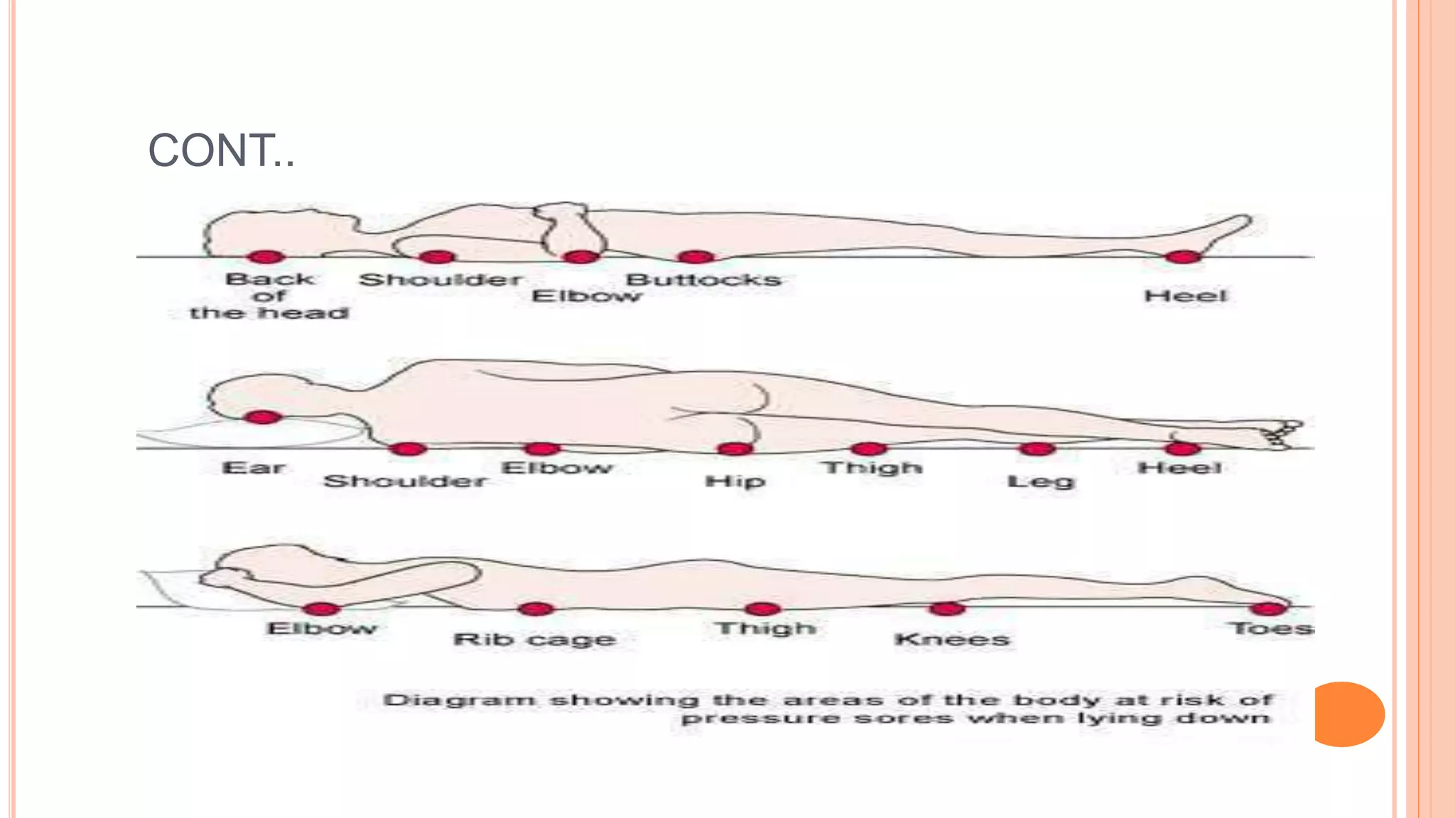 Prevention of Bed Sore Injuries in ICU patients.pptx