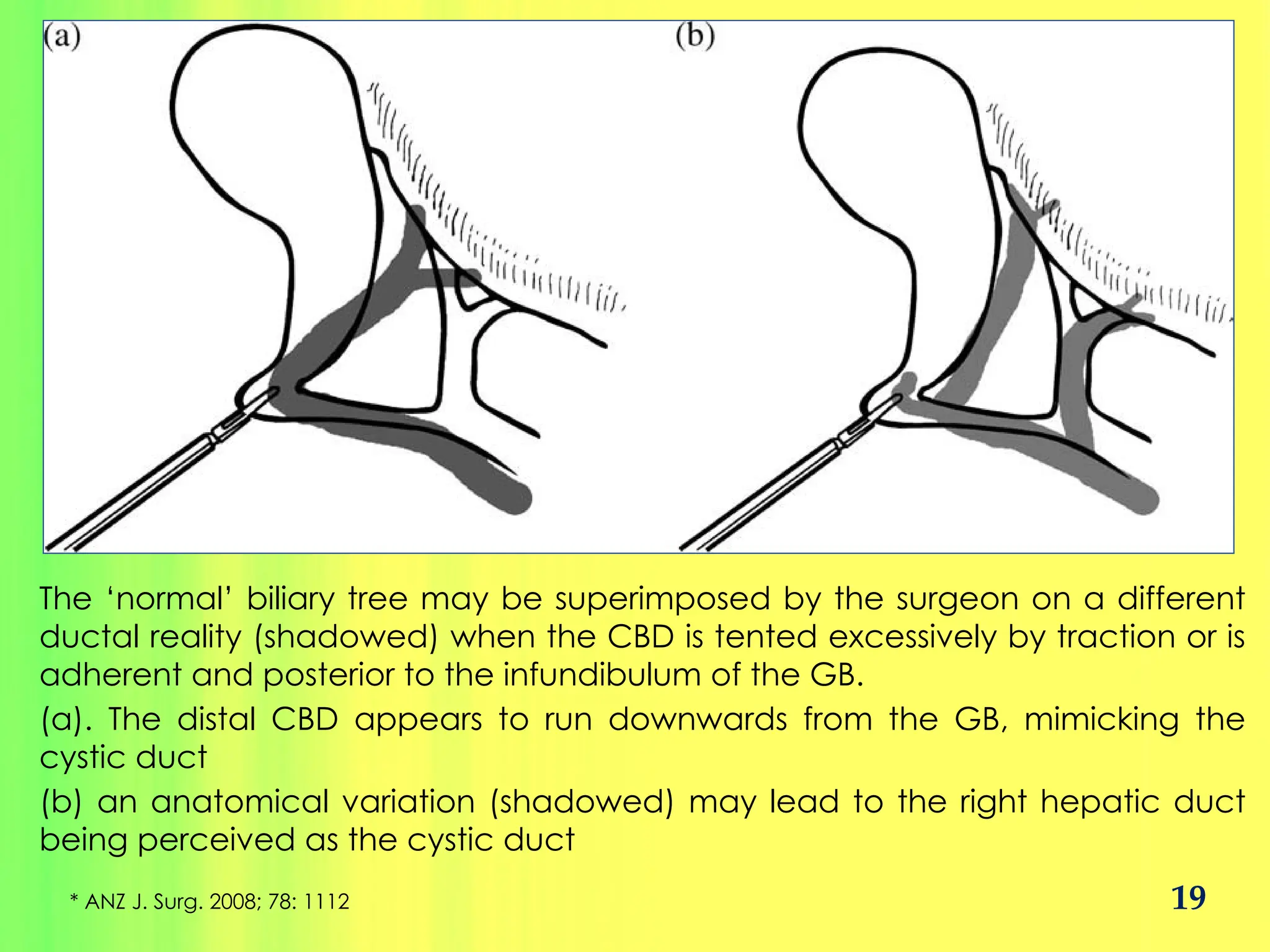 Prevention of Bile Duct Injury in Difficult Lap Chole.pptx