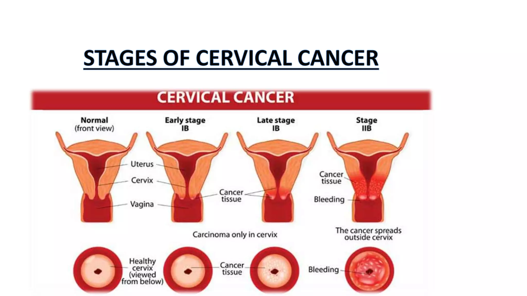 Cervical Cancer [ Incidence, Prevalence, Research Study, Introduction ...