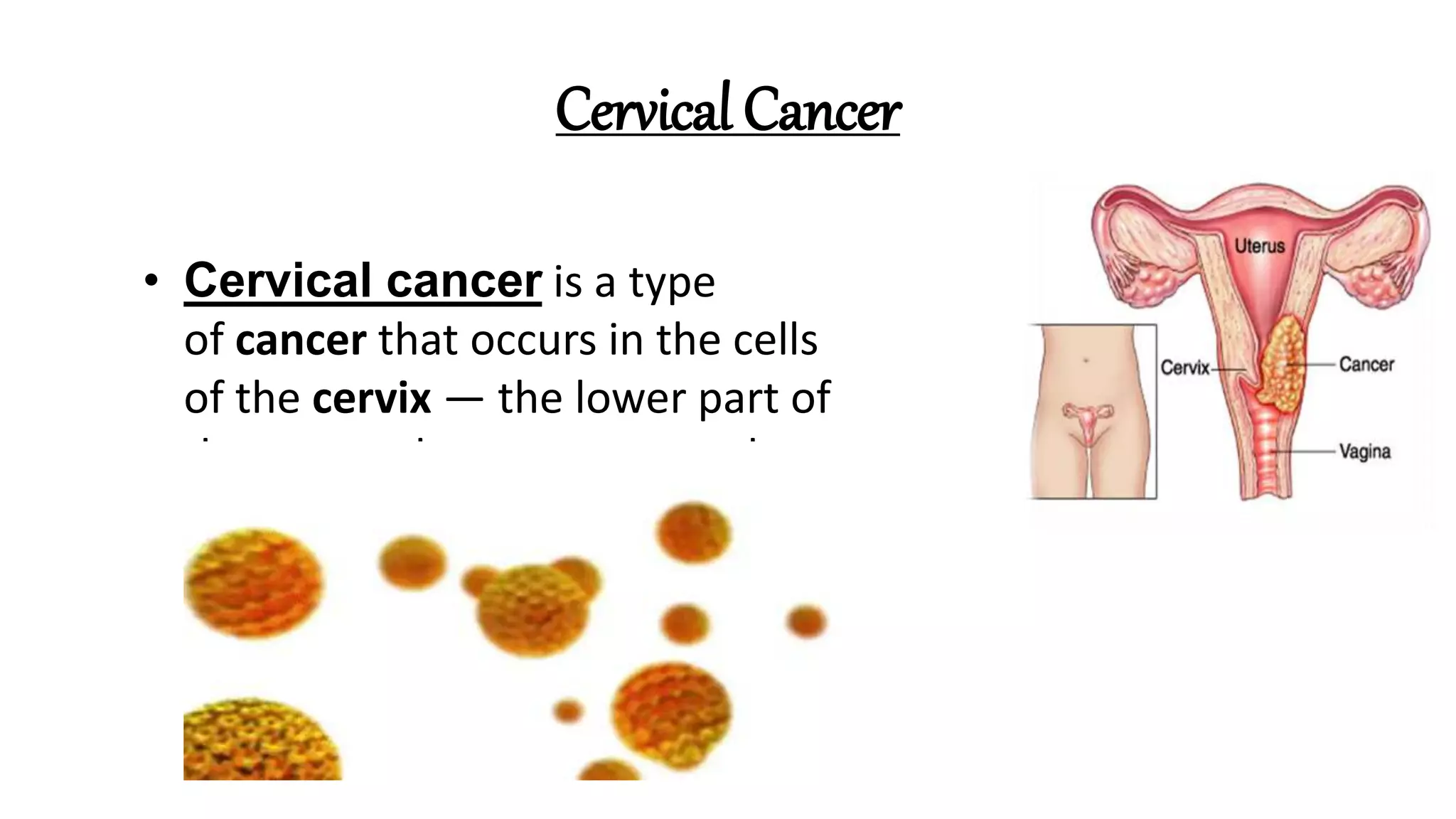 Cervical Cancer [ Incidence, Prevalence, Research Study, Introduction ...