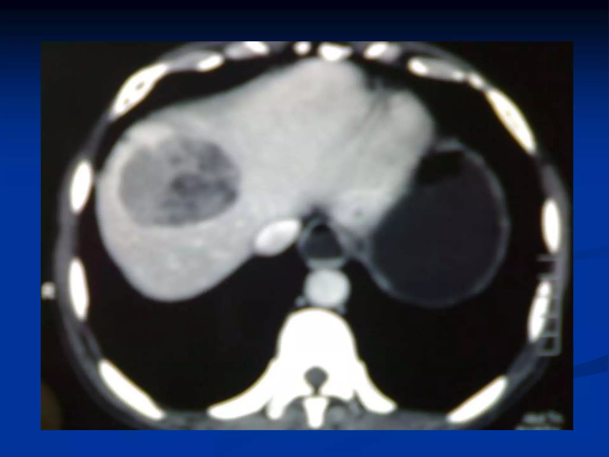 Prevention of HCC.ppt