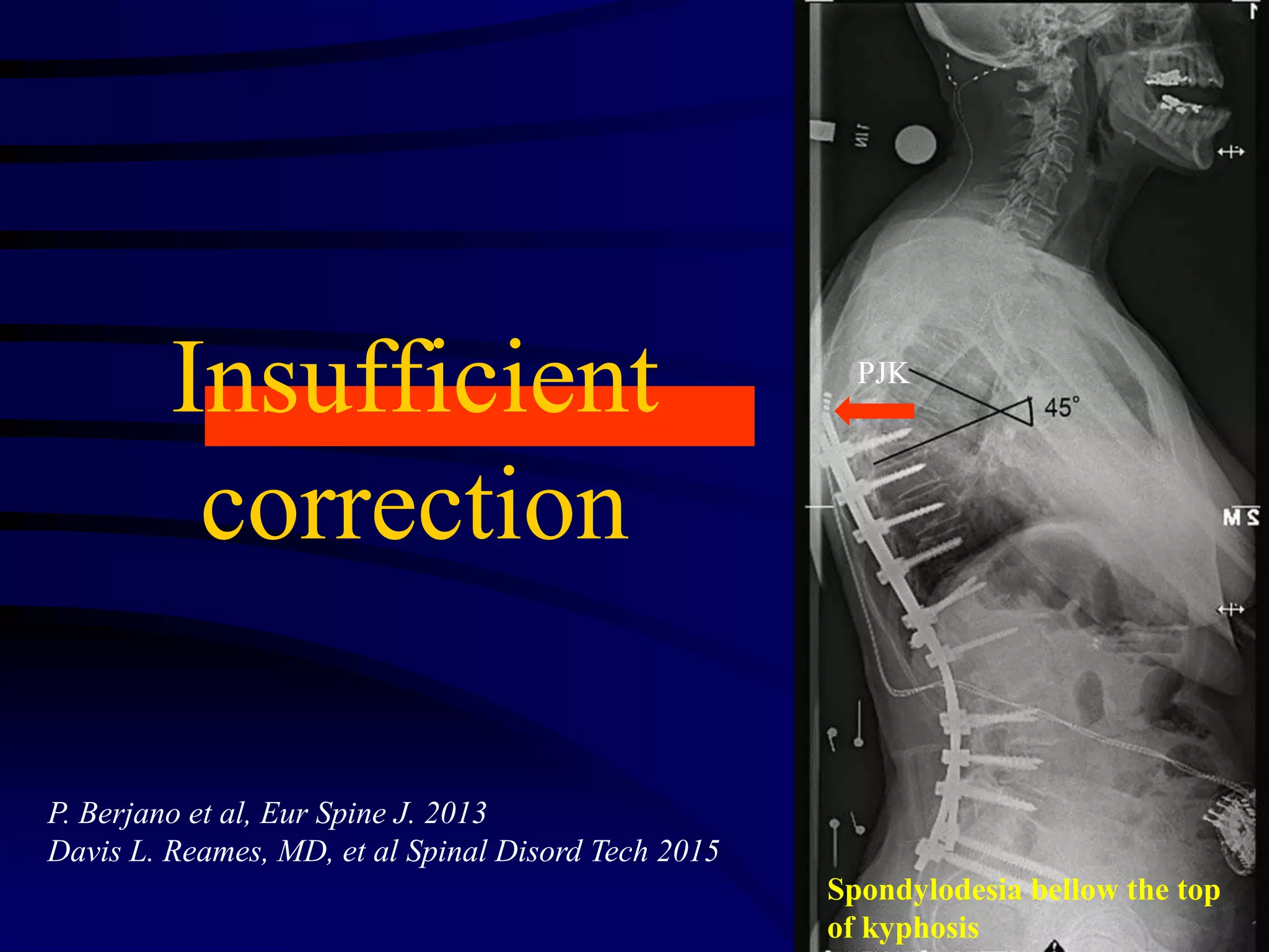 PREVENTION OF IMPLANTS FAILURE IN SPINE SURGERY NOV..2022.ppt