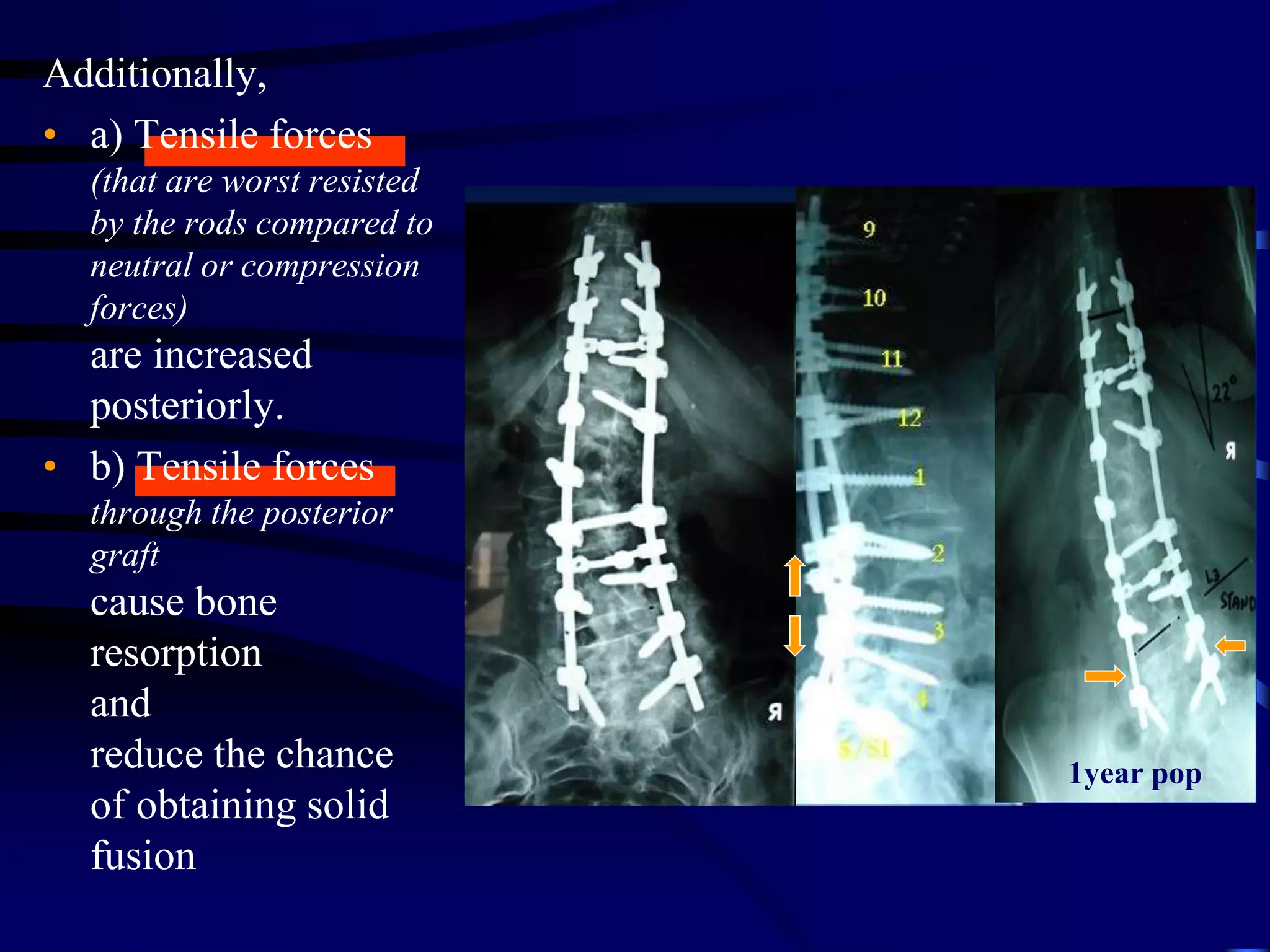 PREVENTION OF IMPLANTS FAILURE IN SPINE SURGERY NOV..2022.ppt