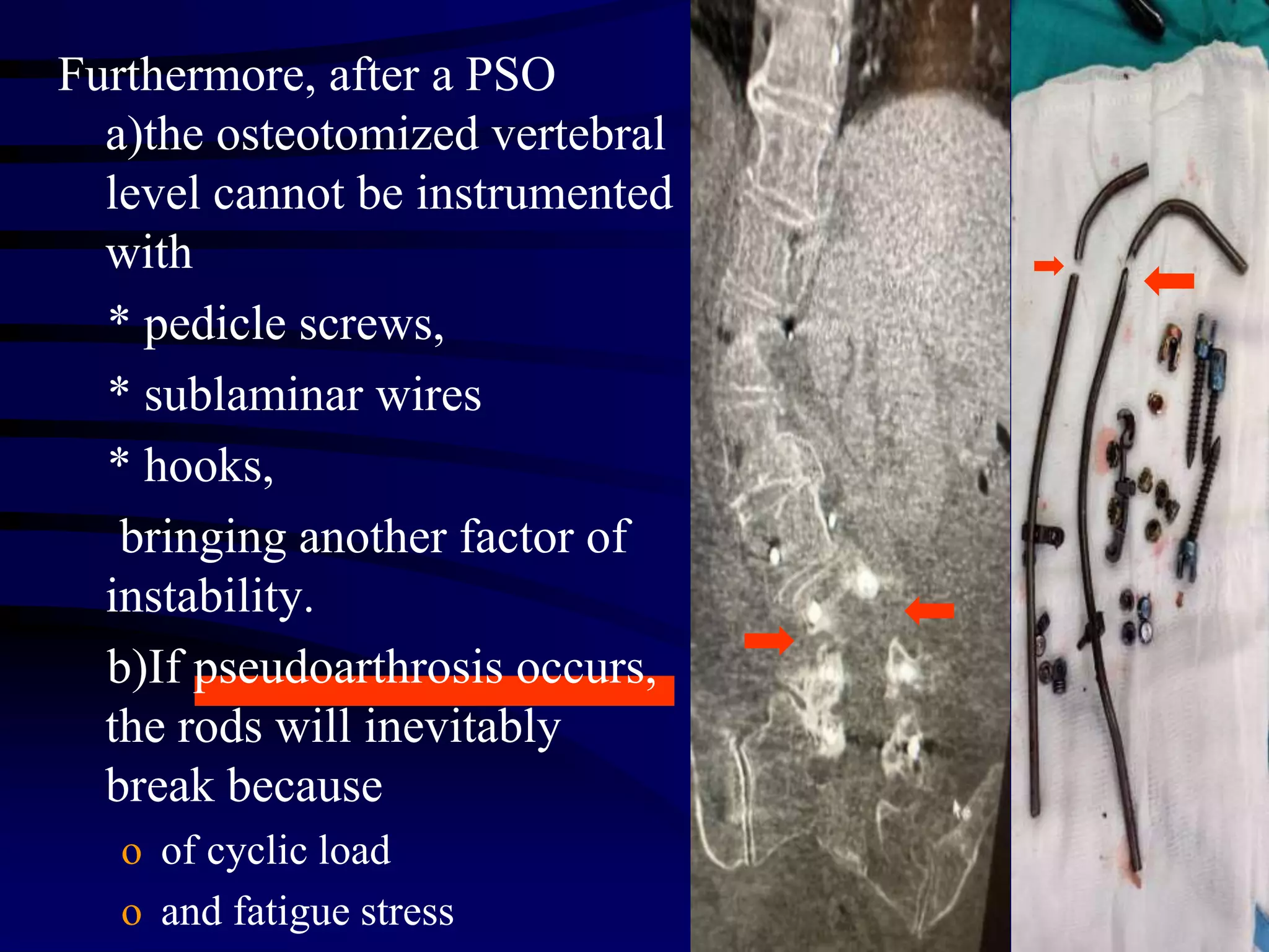PREVENTION OF IMPLANTS FAILURE IN SPINE SURGERY NOV..2022.ppt