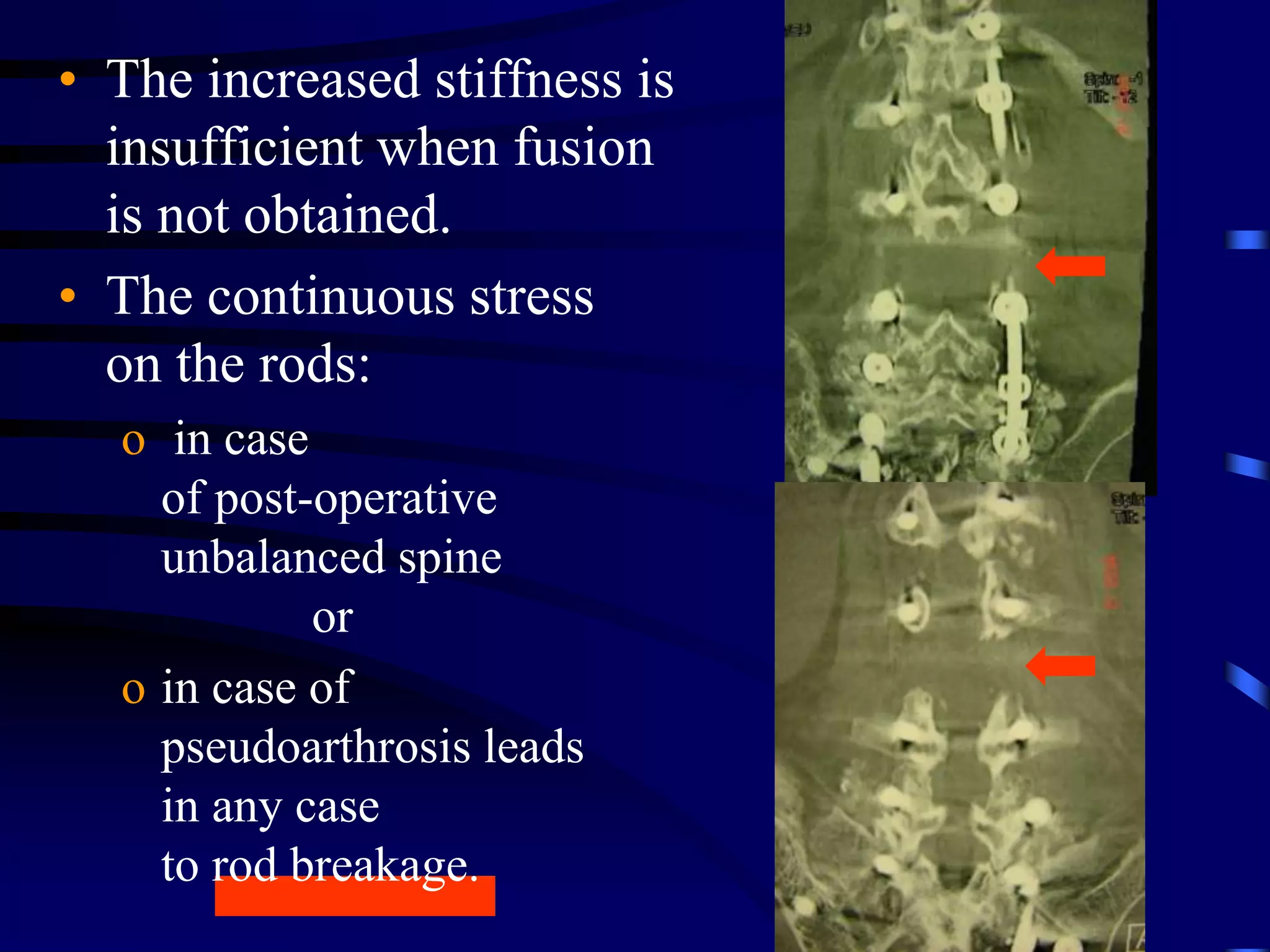 PREVENTION OF IMPLANTS FAILURE IN SPINE SURGERY NOV..2022.ppt