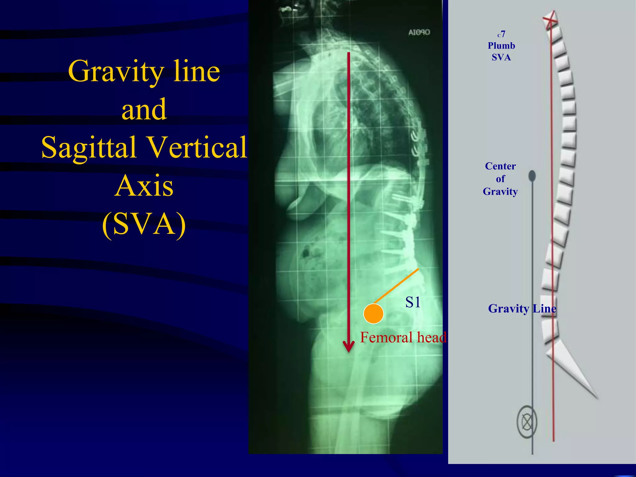 PREVENTION OF IMPLANTS FAILURE IN SPINE SURGERY NOV..2022.ppt