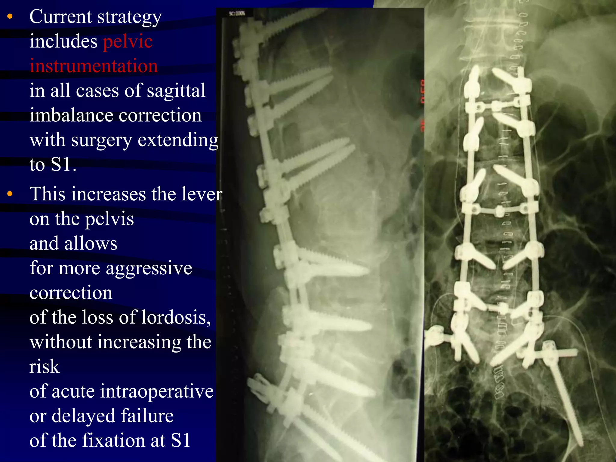 PREVENTION OF IMPLANTS FAILURE IN SPINE SURGERY NOV..2022.ppt