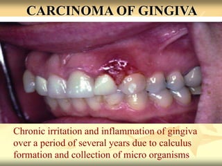 PREVENTION OF ORAL CANCER - ppt | PPT