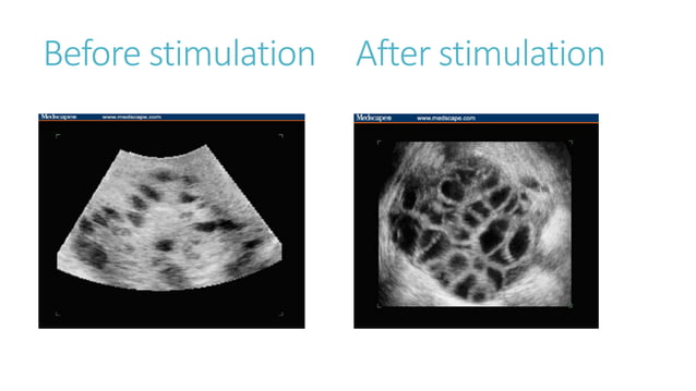 Prevention of ovarian hyperstimulation syndrome | PPTX | Infertility ...