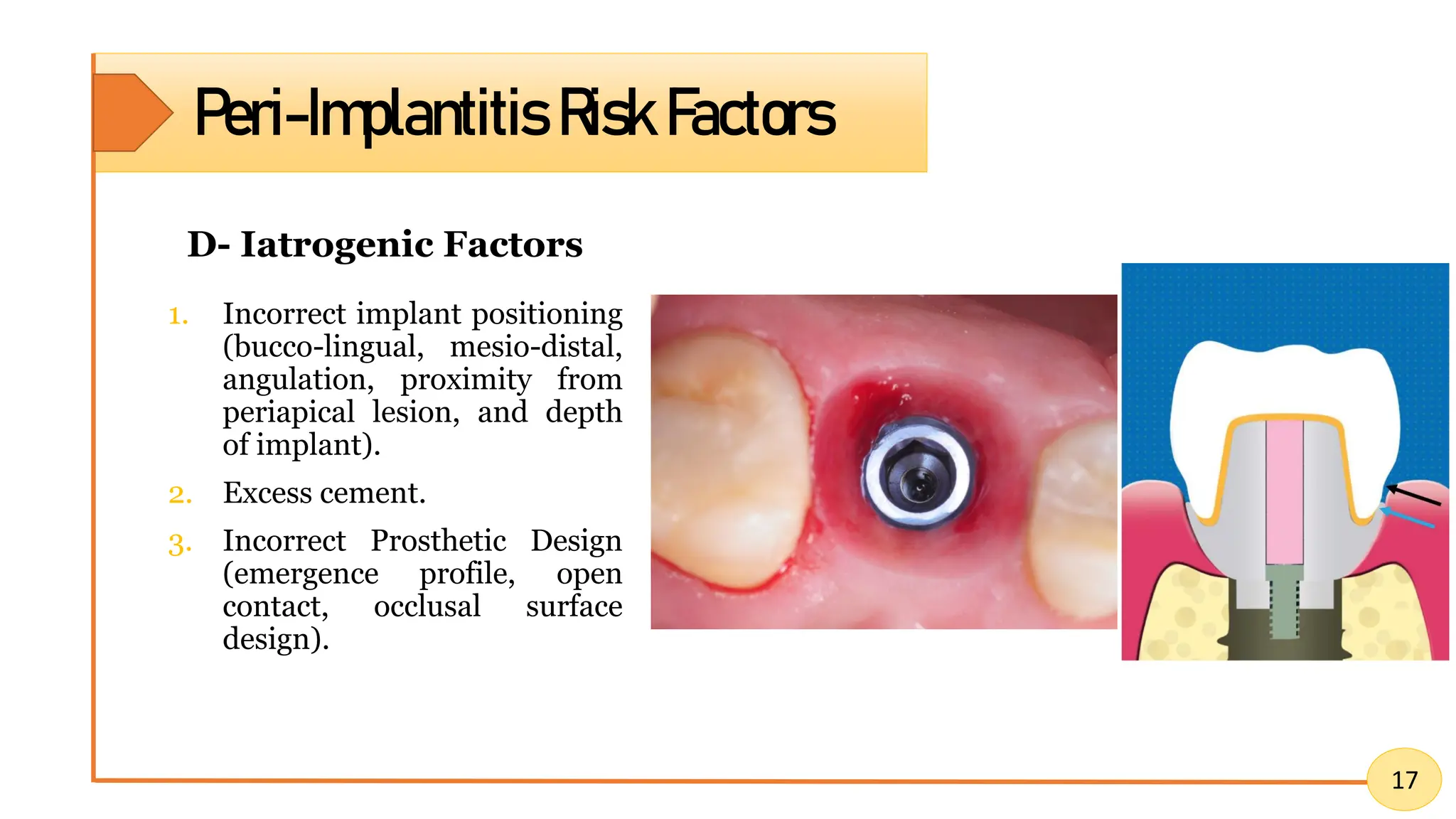 prevention of peri implant disease 8.pdf