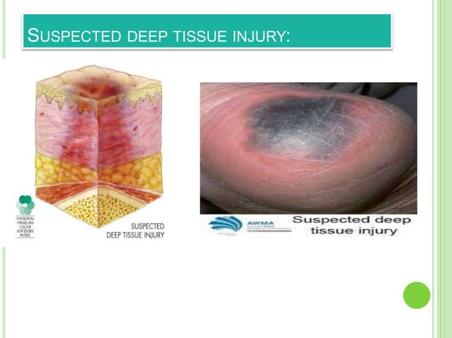 PREVENTION OF PRESSURE ULCER/BED SORE/PRESSURE SORE | PPTX