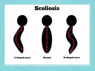 Prevention of spine deformities in children and adults ( Scoliosis ...