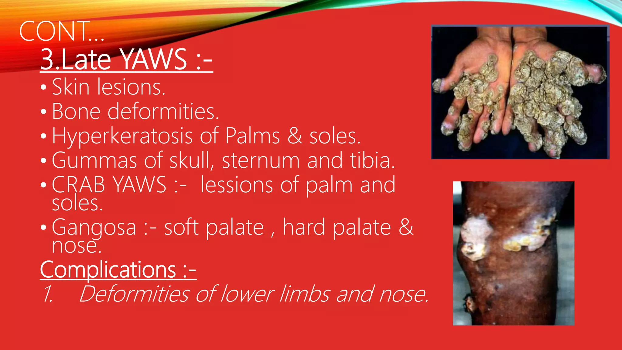 Prevention of yaws roge ppt | PPTX