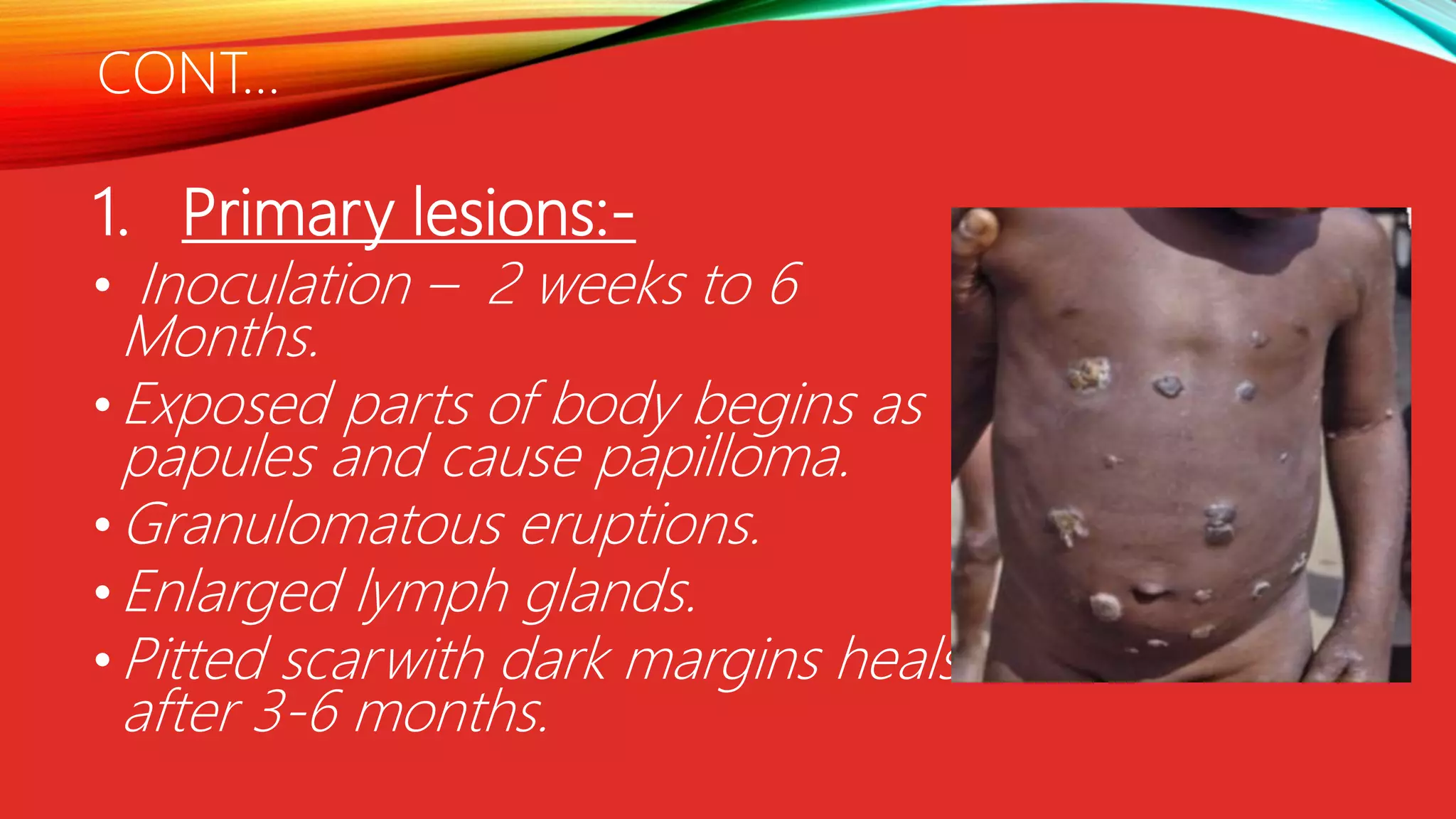Prevention of yaws roge ppt | PPTX