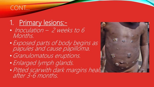 Prevention of yaws roge ppt | PPT