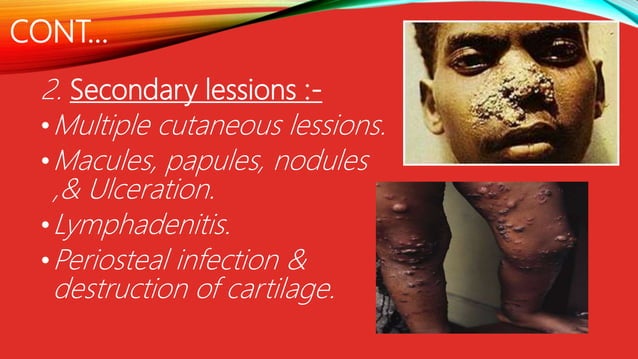 Prevention of yaws roge ppt | PPT