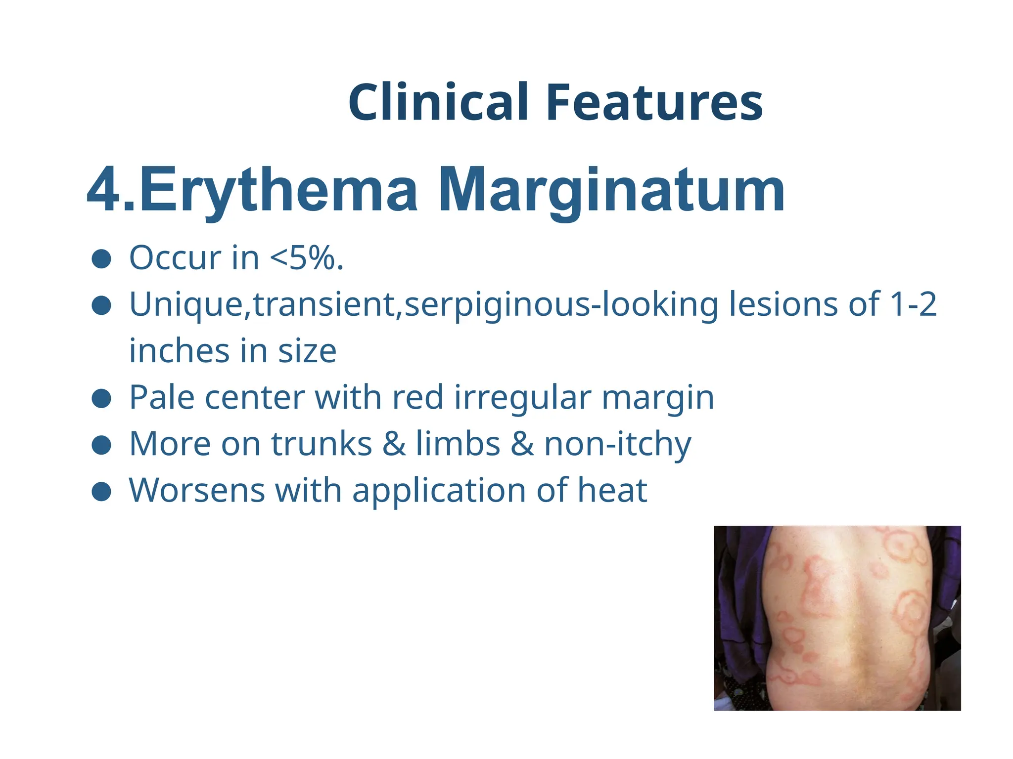 Prevention & Treatment of Rheumatic fever.ppt