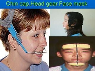 Preventive And Interceptive Orthodontics | PPT