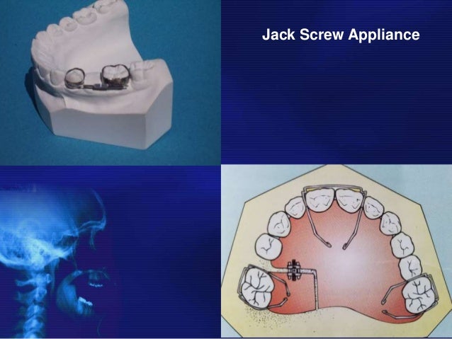 Preventive and Interceptive Orthodontics in Pediactric Dentistry