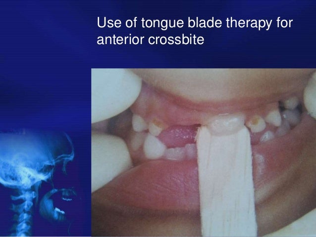 Preventive and Interceptive Orthodontics in Pediactric Dentistry