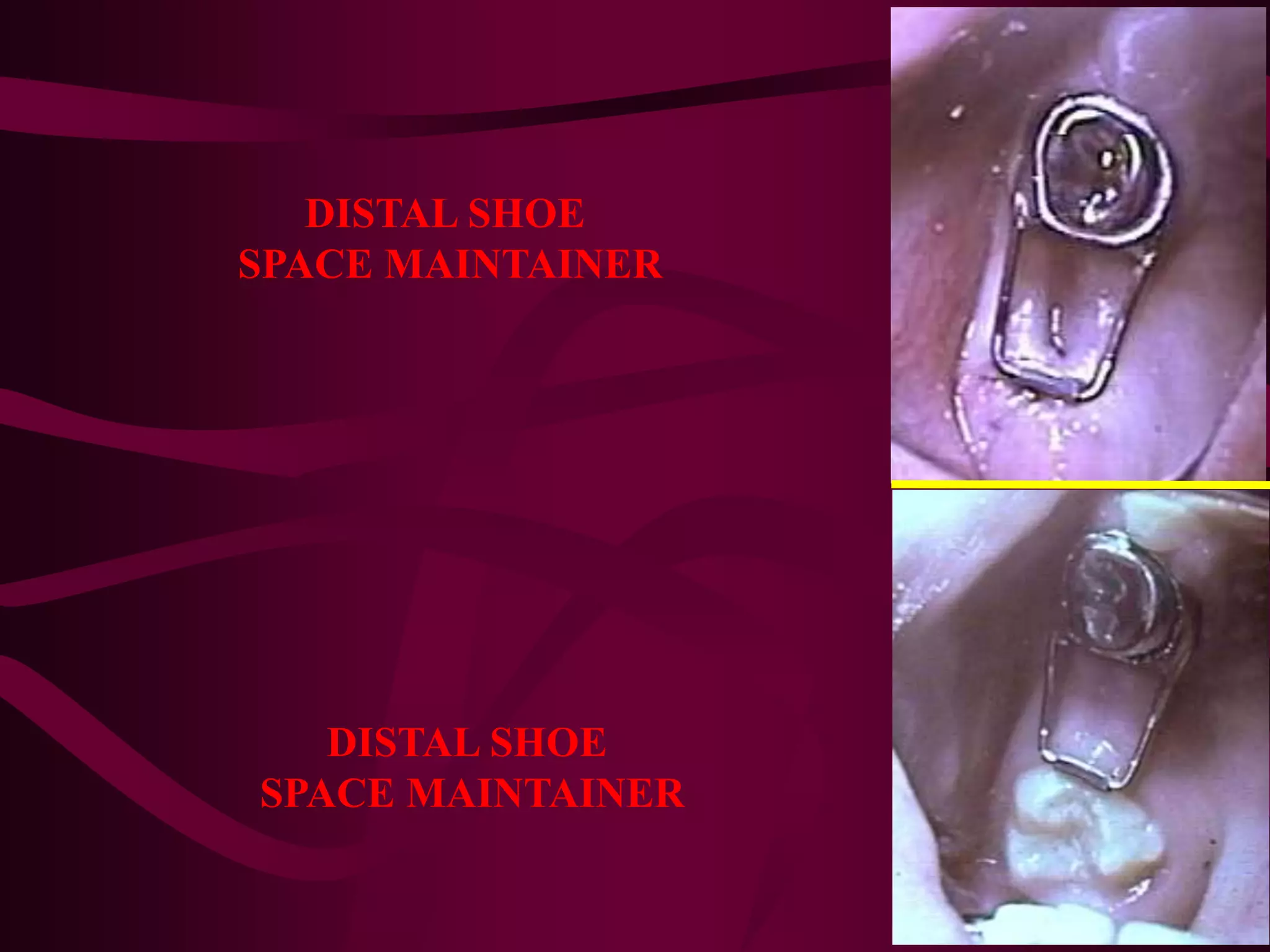 Preventive Orthodontics | PPT