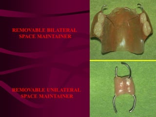 Preventive Orthodontics | PPT