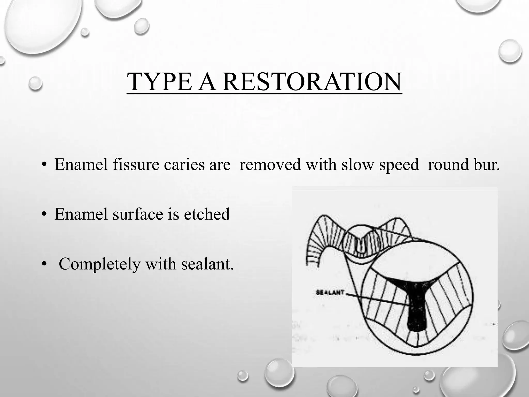 Preventive resin restoration | PPTX