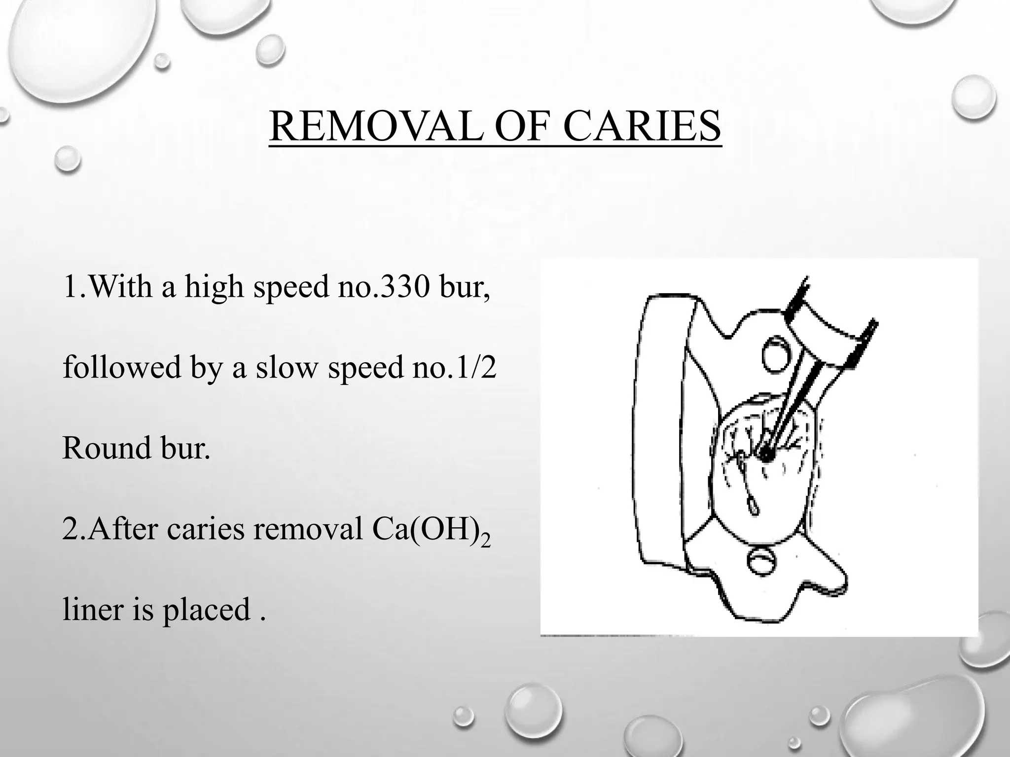 Preventive resin restoration | PPTX