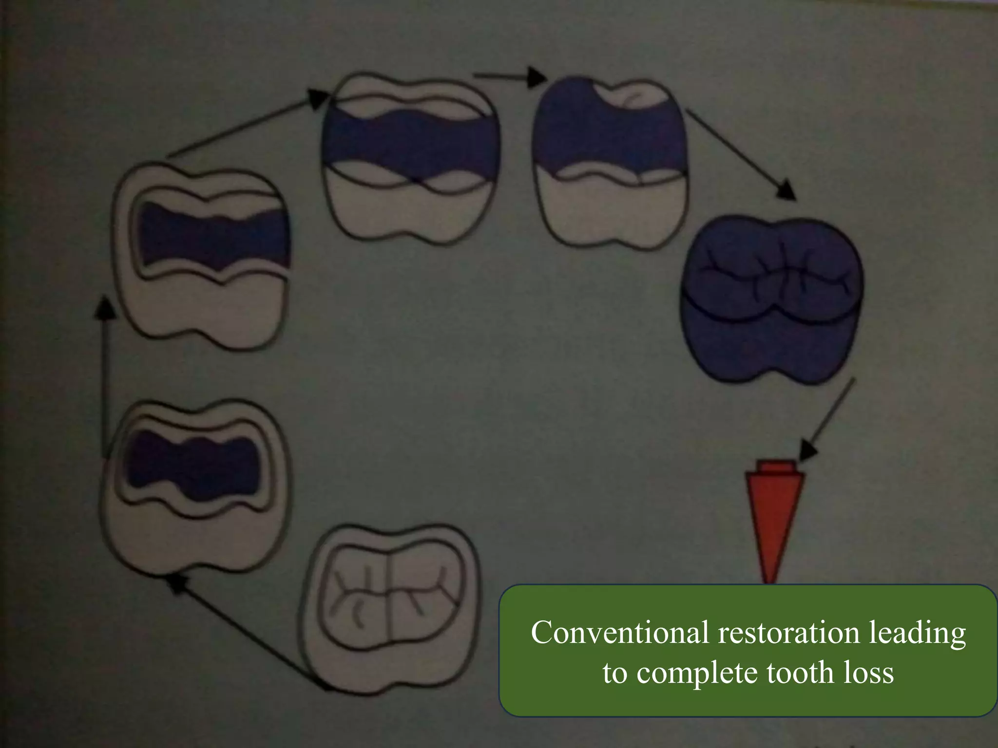 Preventive resin restoration | PPTX