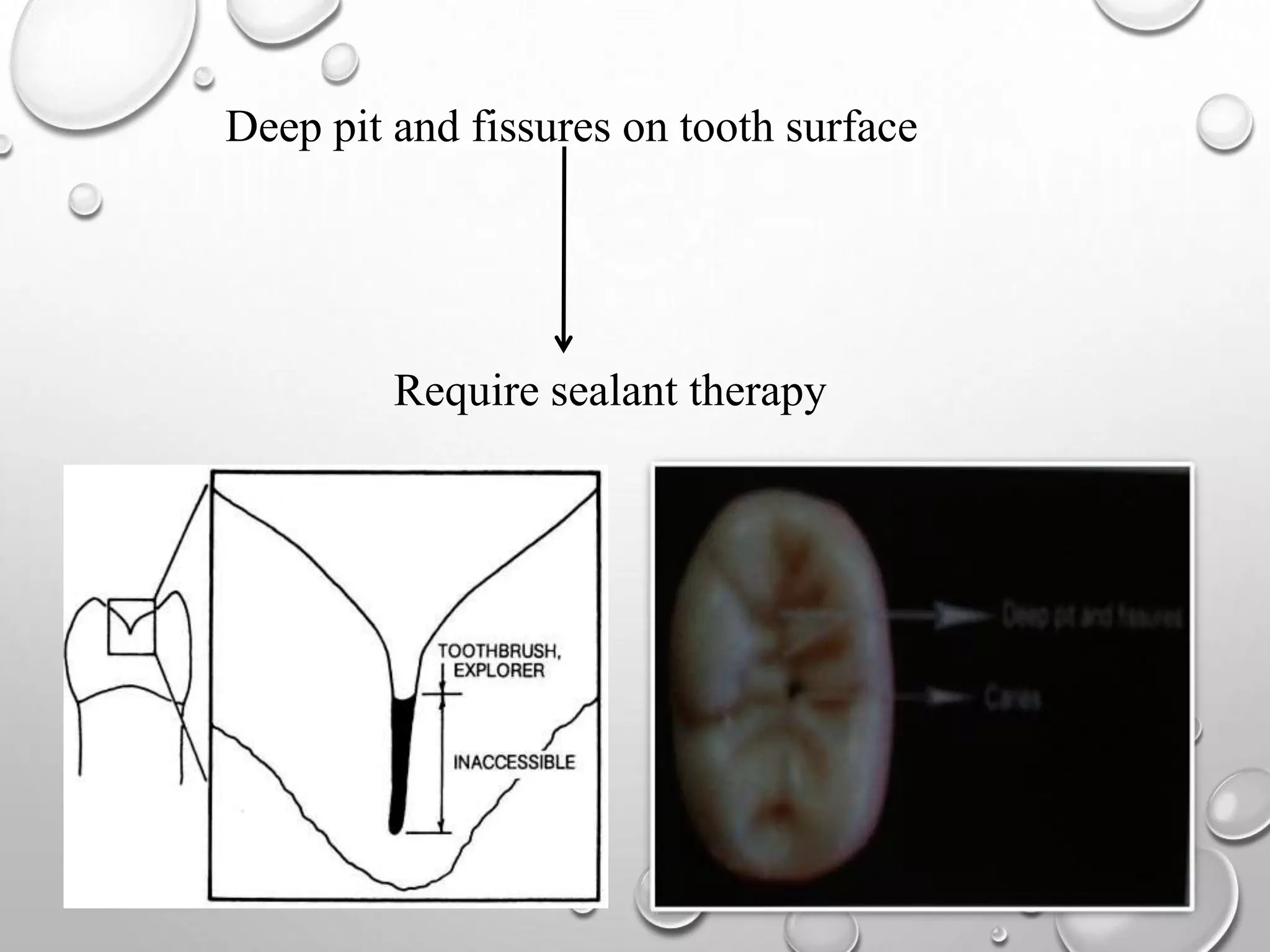 Preventive resin restoration | PPTX