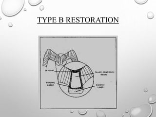 Preventive resin restoration | PPTX