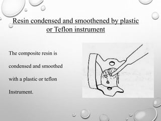 Preventive resin restoration | PPTX