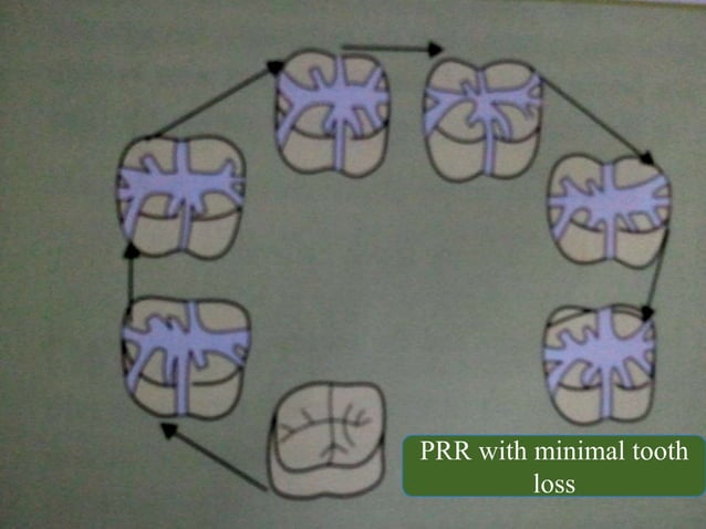 Preventive resin restoration | PPTX | Dental Health | Diseases and ...