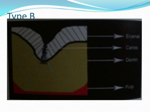 Preventive resin restoration ppt | PPTX