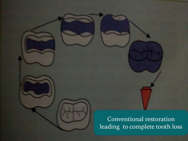 Preventive resin restoration ppt | PPTX