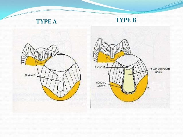 Preventive resin restoration ppt